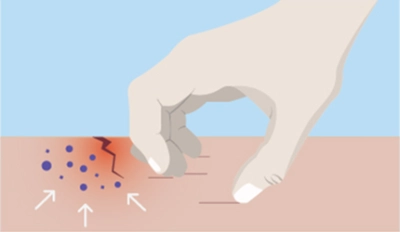 What Causes Atopic Dermatitis